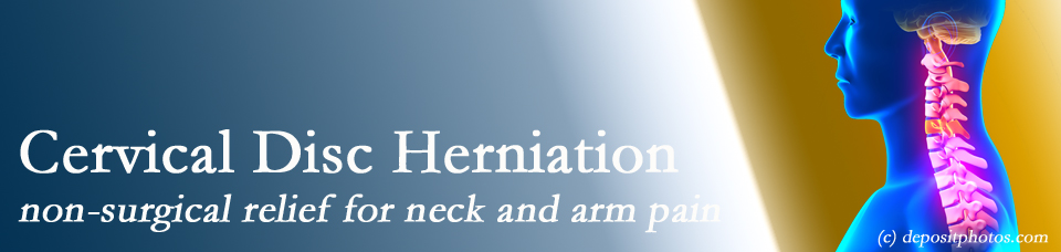 St Peters Cervical Disc Herniations Respond to Non-Surgical Treatment ...