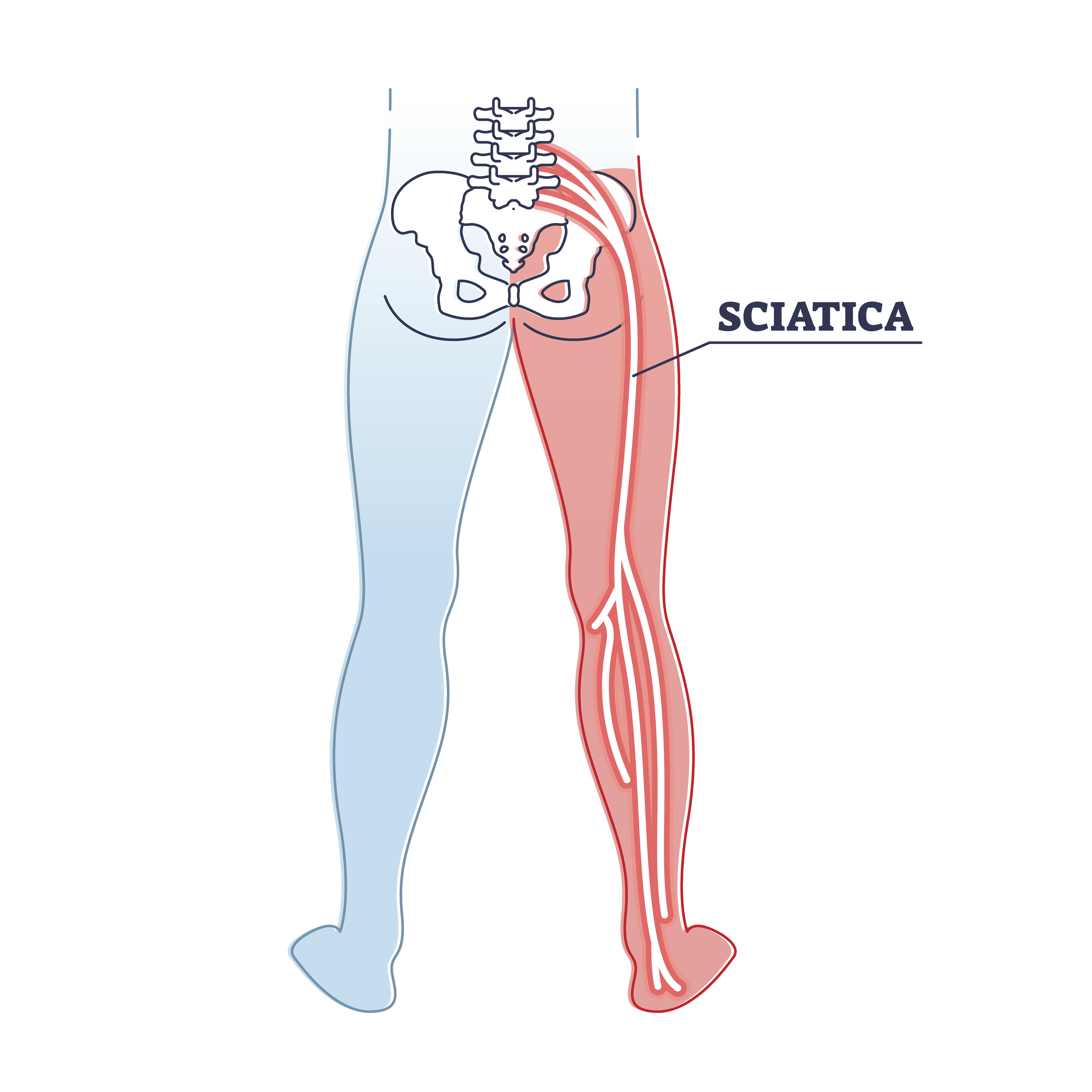 St Peters Chiropractic and Cox Technic: A Path to Relief of Sciatic ...